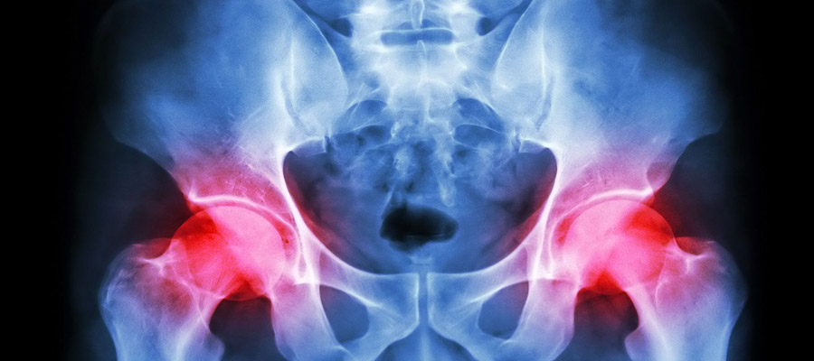 Origine de la douleur de l’arthrose cervicale